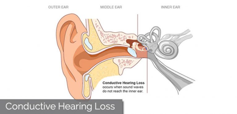 Conductive Hearing Loss | Causes, Symptoms & Best Treatment