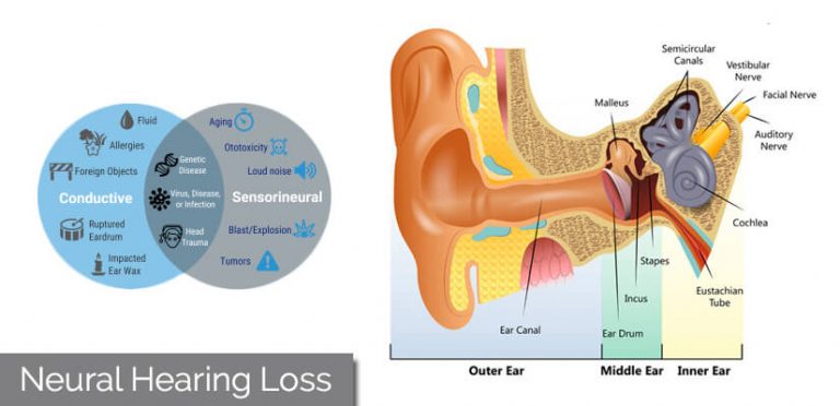Neural Hearing Loss | Take Hearing Loss Best Treatment 2020