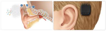 Difference Between Bone Anchored Implant And Cochlear Implant