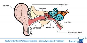 Ruptured Eardrum (Perforated Eardrum) - Know Best Treatment