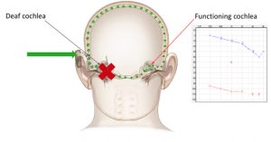 Sudden Unilateral Hearing Loss In One Ear | Best Guide 2020
