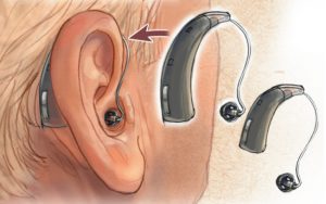 Receiver In Canal (RIC) Hearing Aids - Features, Price & Advantages