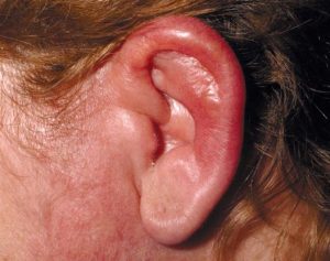 Ear Eczema - Symptoms, Causes, Treatment & Best Remedies